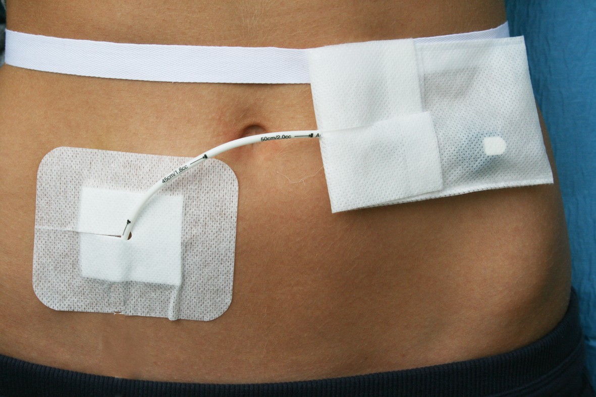 UTILIZZO EXIT-POCKET PT E EXIT-PRO AG INSIEME | Emodial